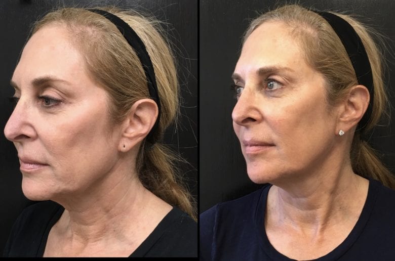 The New Neck Lift: We Tried Botox In Our Neck - In The Groove